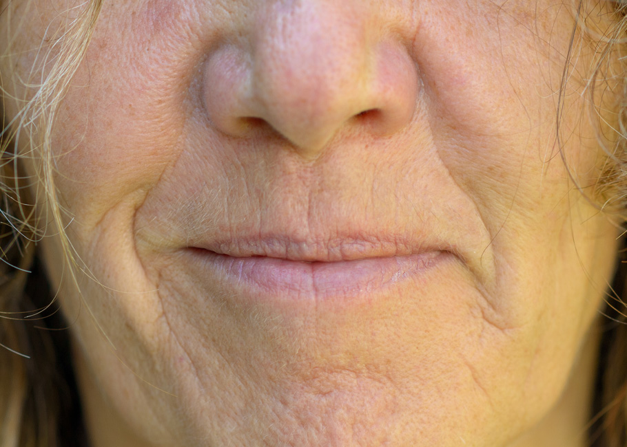 Treatments For Facial Volume Loss York | Katrina Tootell Aesthetics