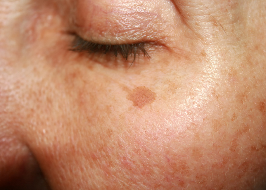 Treatments For Pigmentation York | Katrina Tootell Aesthetics